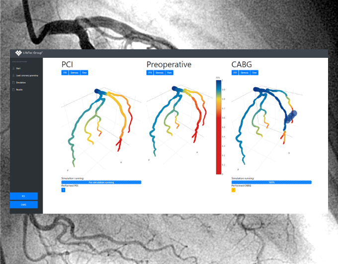 ANGIOSUPPORT | LifeTec Group